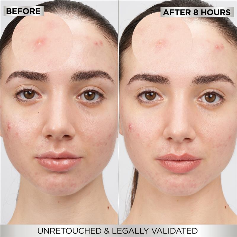 Buy Garnier Pure Active Pimple Patches 44 Pack Online at Chemist Warehouse®